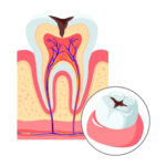 The 5 Stages of Tooth Decay & How to Stop It Early | Cedar Walk Dentistry